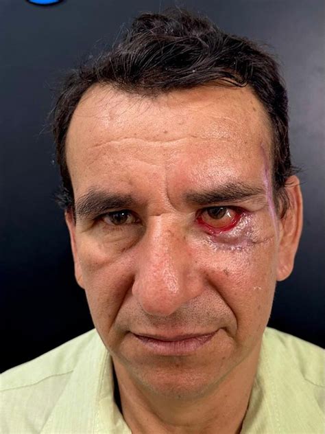 Carcinoma Basocelular Nodular Oculoplastia