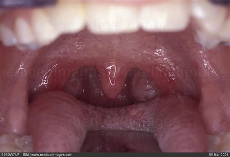 Lump On Tonsil