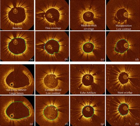 Examples Of Automated Stent Strut Detection In Cases With Different Download Scientific Diagram