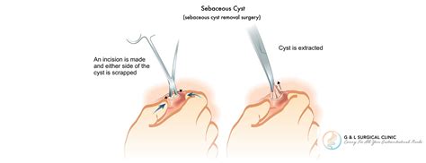 Pre Post Care Excision Biopsy G And L Surgical Clinic Dr Ganesh