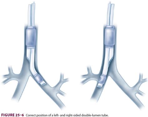 Techniques For One Lung Ventilation