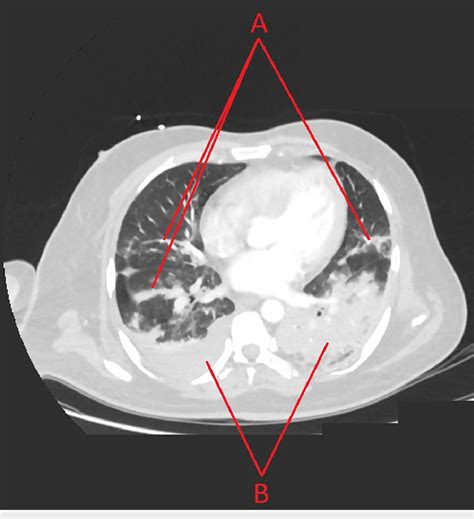 A Ct Pulmonary Angiography A Bilateral Patchy Consolidation Denoting