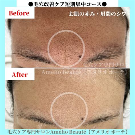 額眉間のボコボコ毛穴が変わりました 群馬県太田市 東京都渋谷区表参道 凸凹毛穴開き毛穴すり鉢毛穴 毛穴ケア専門サロンアメリオ ボーテ