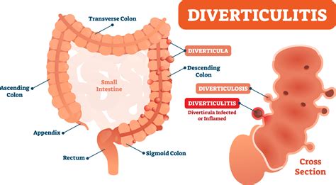 Diverting Diverticulitis United Ostomy Associations Of America