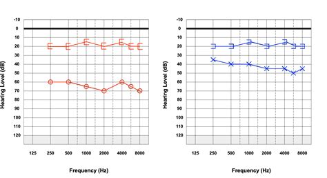 Bilateral Tympanometry At Clara Moran Blog