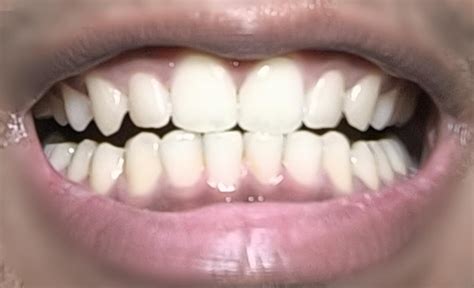 Mewing With An Overbite R Orthotropics