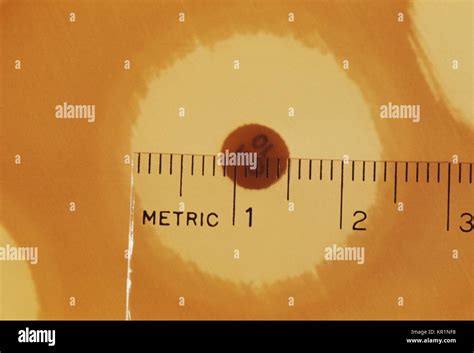 This Image Shows A Lab Technician Measuring The Zone Of Inhibition