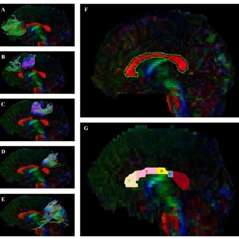 Diffusion Tensor Tractography Of The Corpus Callosum CC With