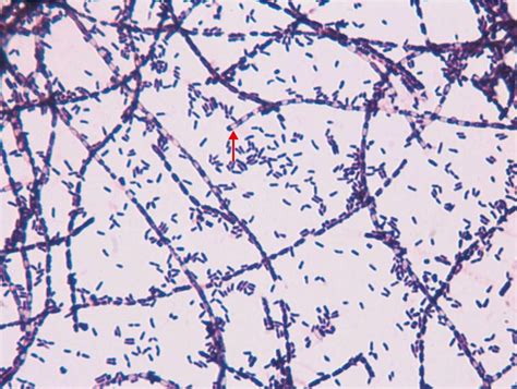 Bacillus Anthracis Anthrax Clinical Tree