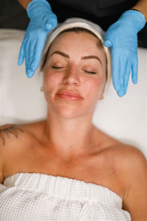 Chemical Peel In Myrtle Beach Sc Jessie The Estie