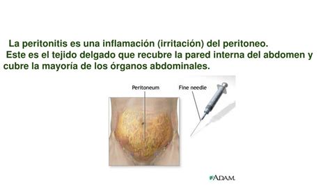 Ppt Peritonitis Powerpoint Presentation Free Download Id 13336148