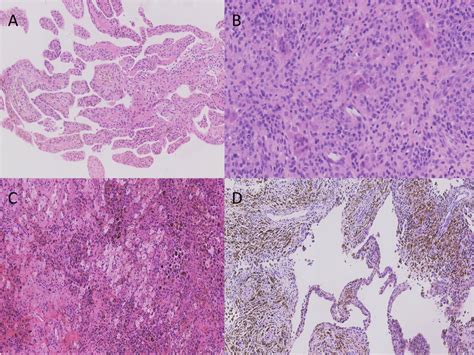 Different Histopathological Features Of Pvns A Large Amount Of