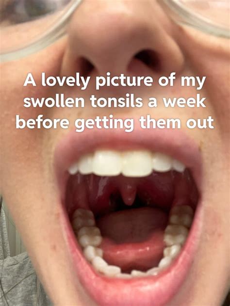 Post Tonsillectomy Surgery R Oralsurgery