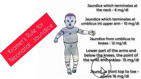 Cramers Rule Jaundice At Reginald Hopkins Blog