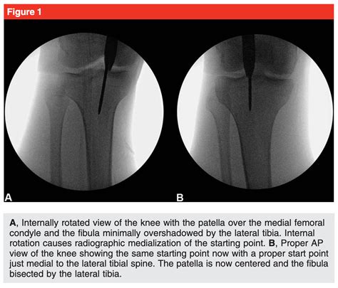 A Review Of Proximal Tibia Entry Points For Intramedullary 52 Off