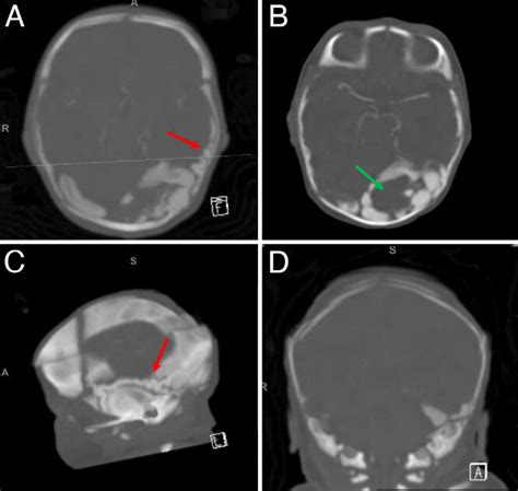 Cta Of The Head Confirmed A Prominent Left Middle Meningeal Artery A