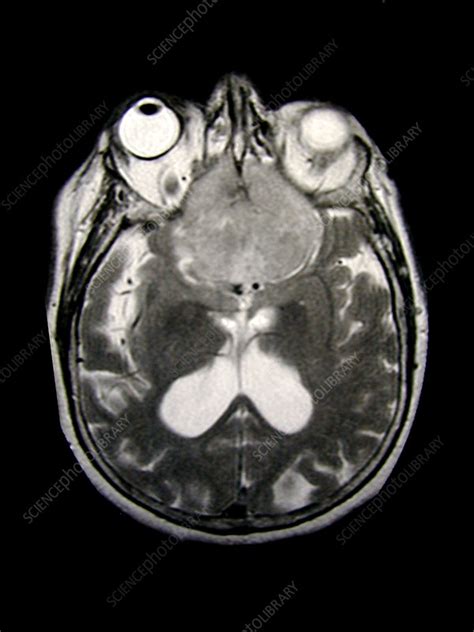 Large Olfactory Groove Meningioma Stock Image M2100354 Science