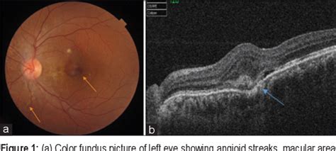 Figure 1 From A Rare Case Of Focal Choroidal Excavation Associated Choroidal Neovascularization