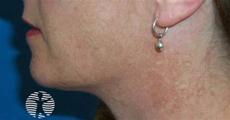 Poikiloderma Of Civatte Image