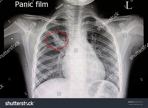 Atelectasis Vs Pneumonia X Ray