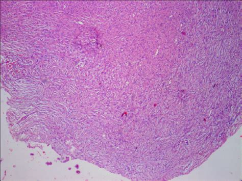Storiform Pattern In Dermatopathology Indian Journal Of Dermatology