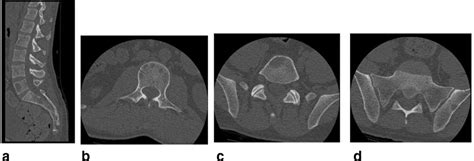 Sagittal Reformat And Axial Ct Scan Of Thecervical Spine Showed Download Scientific Diagram