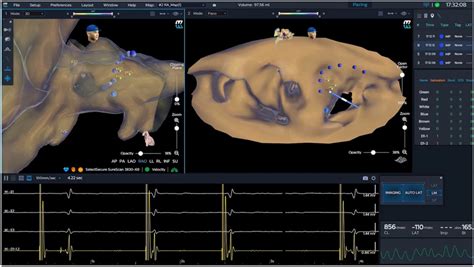 The Kodex Epd Mapping System Showed Three Dimensional Anatomical Image