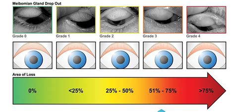 Eye Movement Grading At Zac Ayers Blog