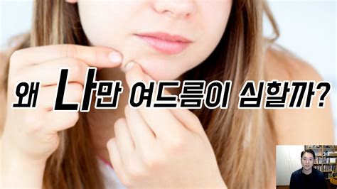 내 여드름이 다른 사람보다 심한 이유 연구가 진행중이다 Youtube