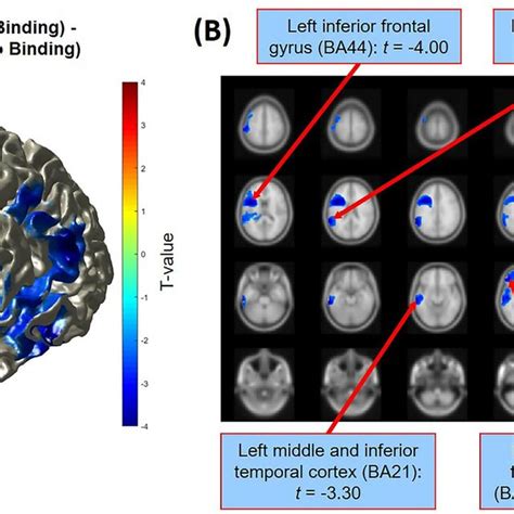 Source Localization Estimates Of The Condition Difference In Alpha