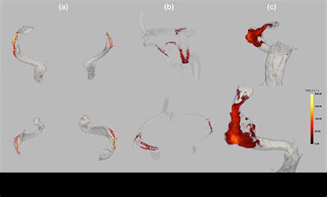 Pulsatile Tinnitus Causes And Treatments Ucsf Radiology