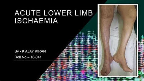 Acute Limb Ischemia Surgical Management Pptx