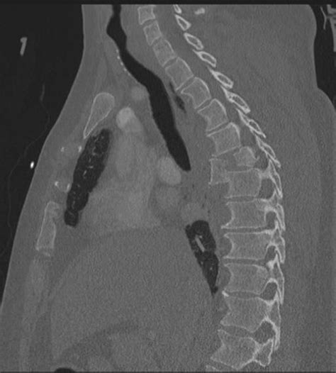 T6 Burst Fracture Radiology Case Radiology
