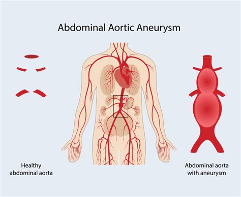 Abdominal Aortic Aneurysm Rupture