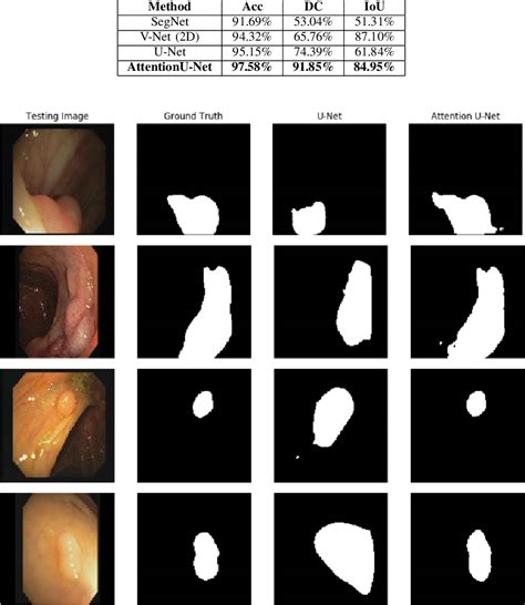Figure 3 From Gastrosegnet Polyp Segmentation Using Colonoscopic Images Based On Attentionu Net
