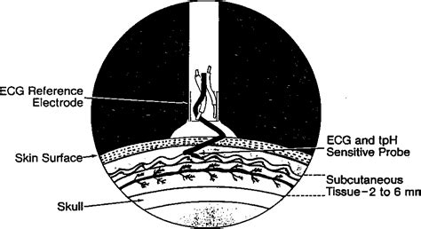 Figure 3 From Continuous Intrapartum Fetal Scalp Tissue Ph And Ecg