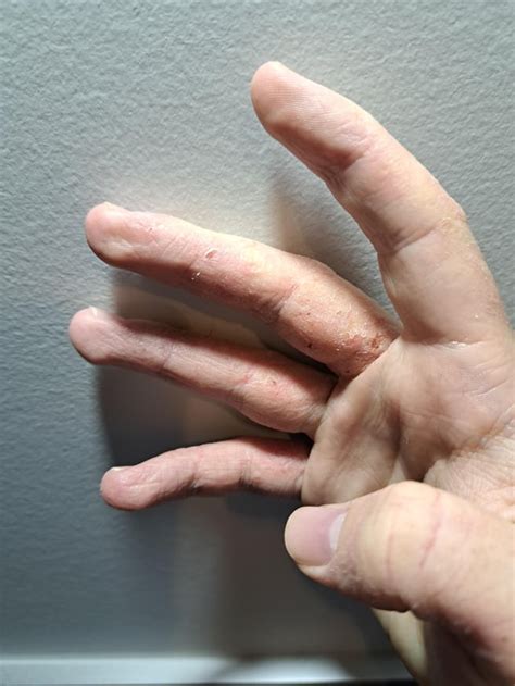Anyone Get Extensive Scaling And Cracking Skin After A Flare R Dyshidrosis