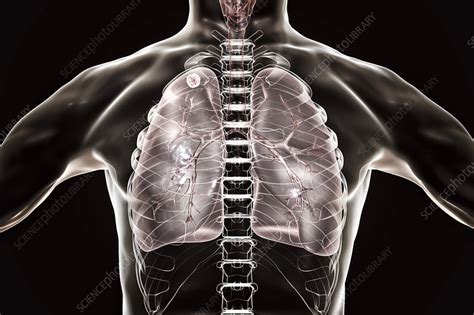 Apical Nodule Secondary Tuberculosis Infection Illustratio Stock Image F022 1999 Science