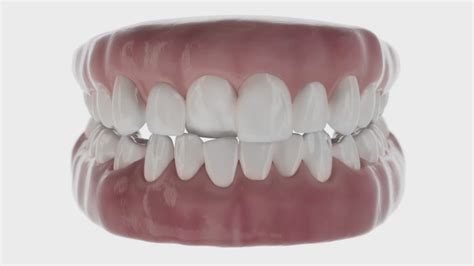 How To Fix A Crossbite Causes And Treatment Bitesoft Dental