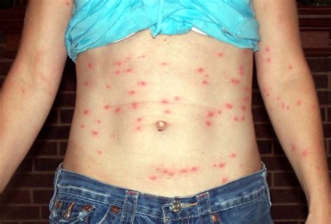 Chigger Bite Treatment Outdoor Life