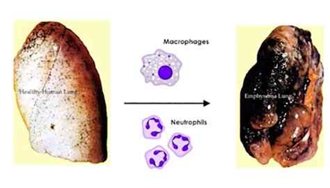 COPD Bridging The Gap Between Science And Clinical Care Research Faculty Of Health Sciences