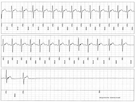 Differentiation Of Convulsive Syncope From Epilepsy With An Implantable