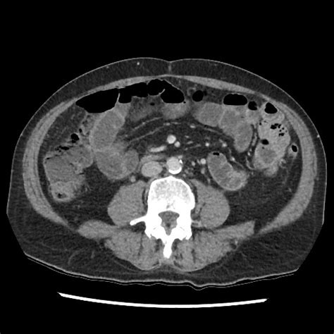 Cholangiocarcinoma Hilar Type Radiopaedia 59780 67205 A Nc Commons