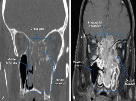 Complete Maxillectomy Clinical Tree