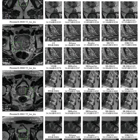 Comparison Of Qualitative Results Of Each Super Resolution Algorithm Download Scientific