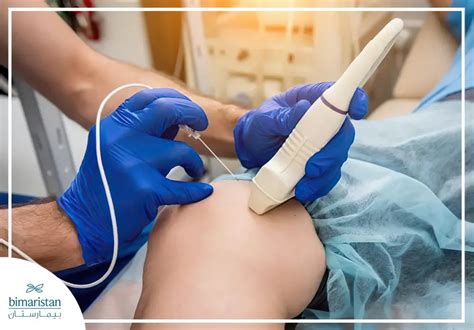 Varicose Vein Embolization In Turkey بيمارستان