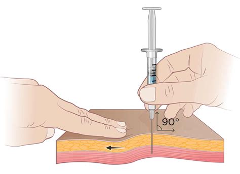 Injection Z Track Method Injection Intramusculaire Voie Z Vinhbx