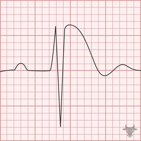 Brugada Syndrome Ecg Stampede