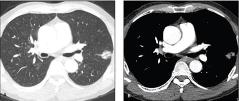 Ground Glass Opacity In Nsclc Linked To Better Five Year Survival Axis Imaging News