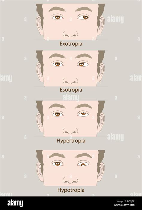Strabismus Defect Esotropia Exotropia Hypertropia Hypotropia Stock